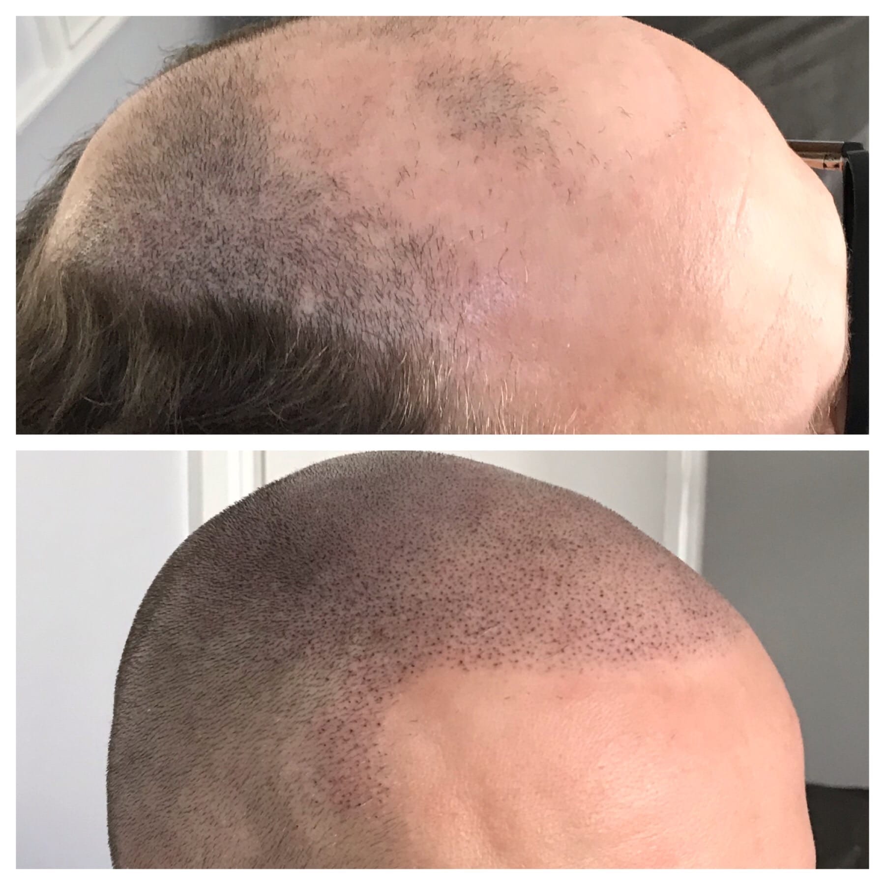 Does Scalp Micropigmentation Look Real And Natural? | MAXIM SMP